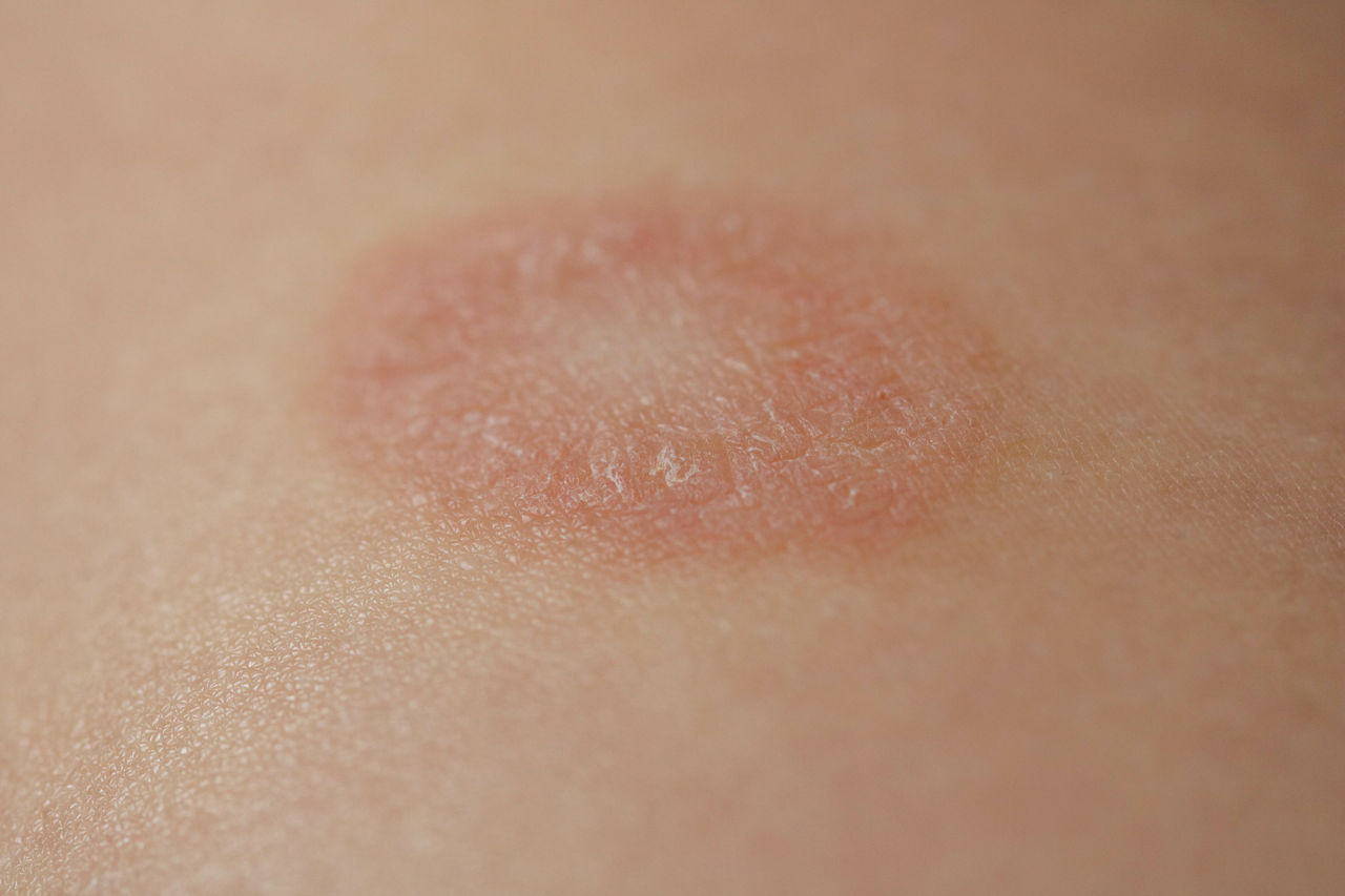 Röschenflechte: Hautrötungen bei Pityriasis rosea erklärt | Helios ...