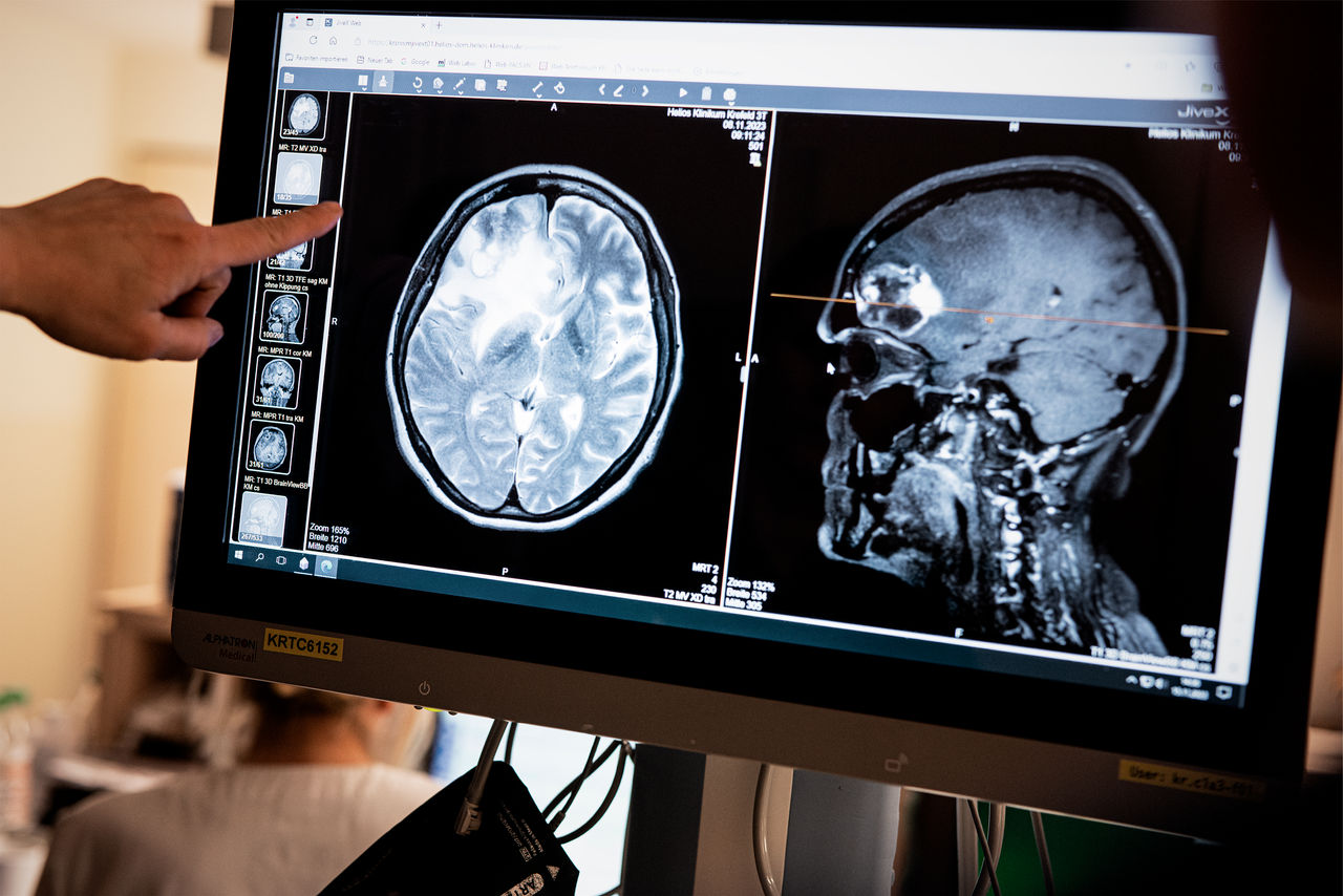 Diagnose Hirntumor- Was tun? | Helios Vogtland-Klinikum Plauen